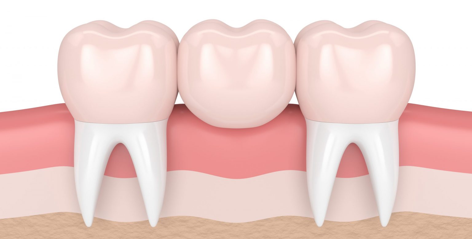 All to know about Full And Partial Dental Bridge | Healing Clinic Turkey