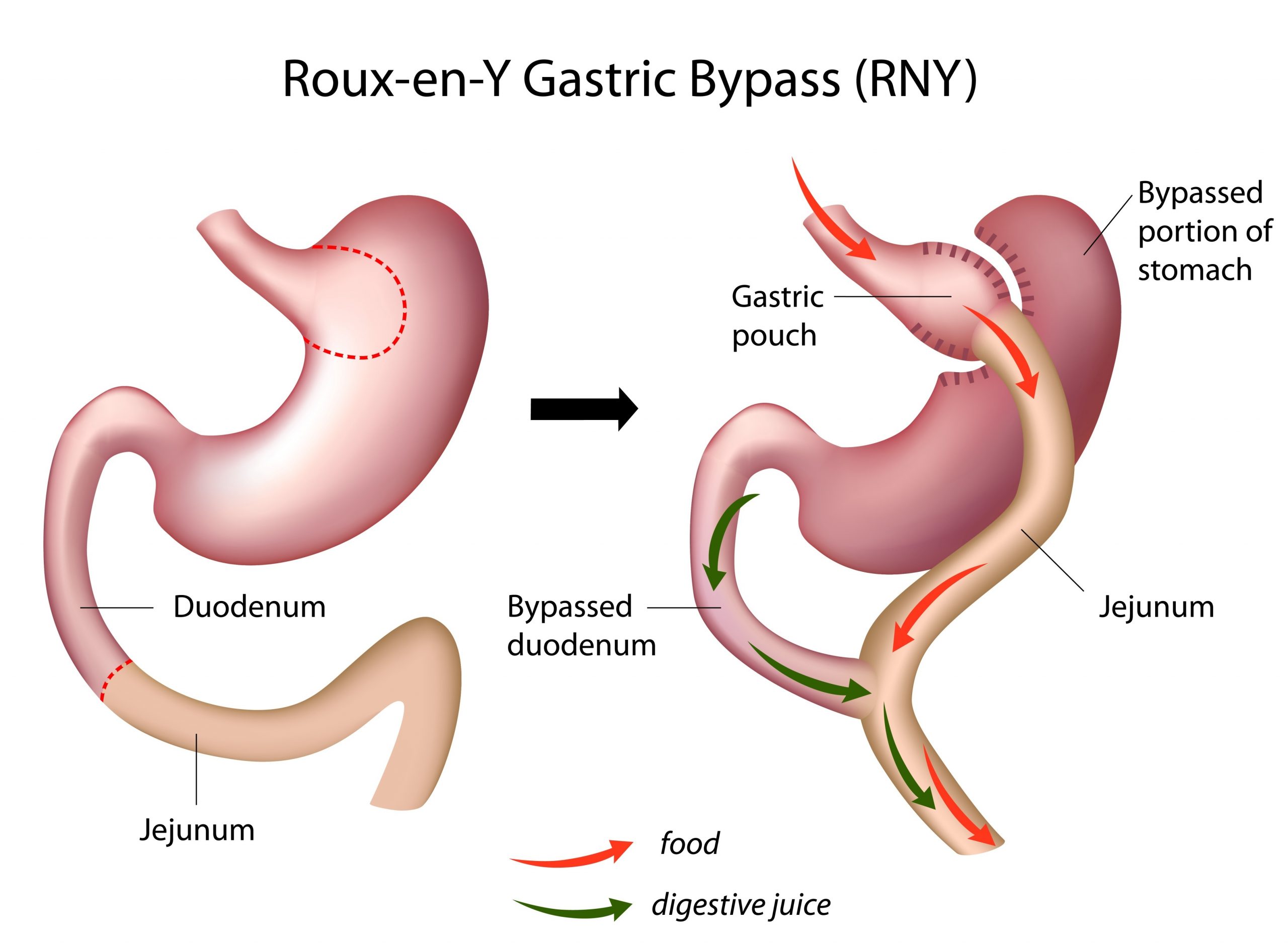 Roux En Y Procedure And All To Know About It Healing Clinic Turkey