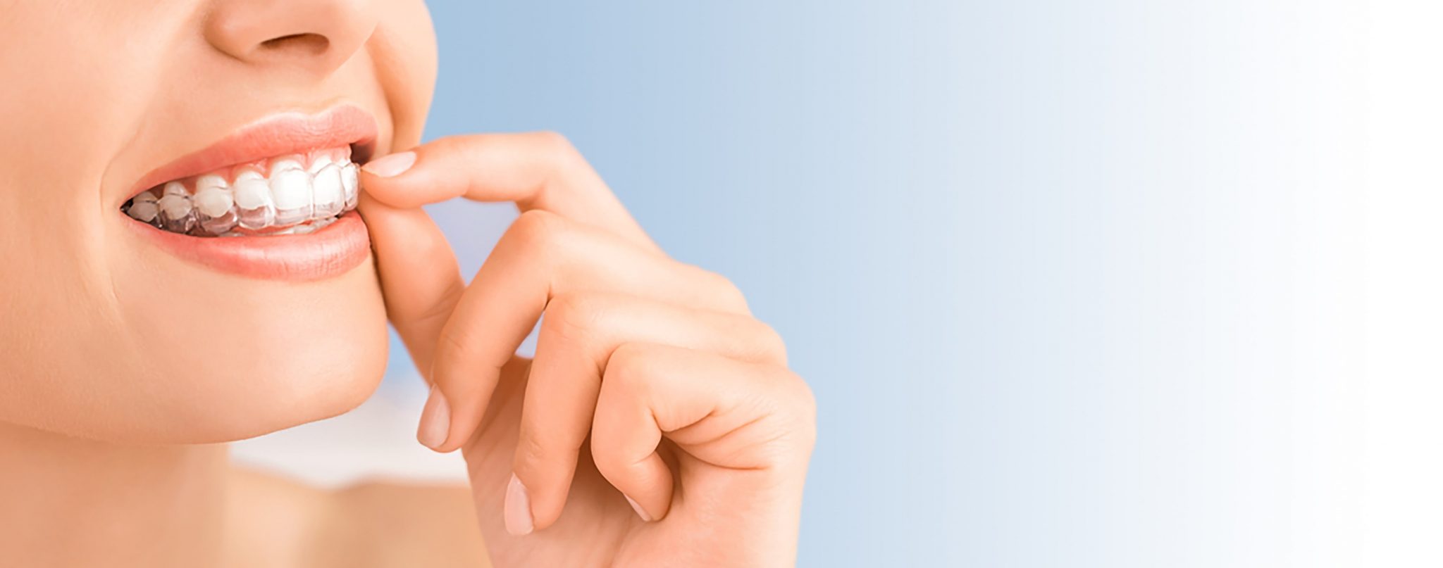 Transparent Teeth Braces and Everything about it | Healing Clinic Turkey